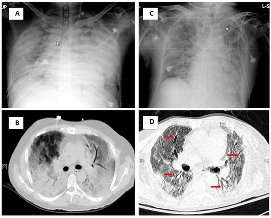 Effects of High-Resolution CT Changes on Prognosis Predictability in ...