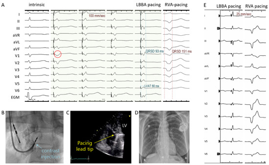 Initial Experience with Left Bundle Branch Area Pacing with ...