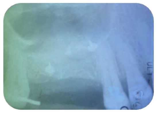 JCM | Free Full-Text | Long-Term Outcomes of Implants Placed in ...