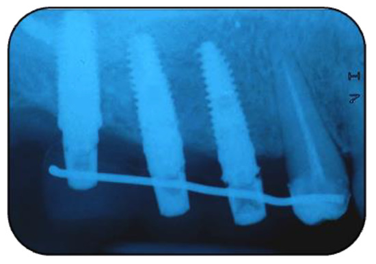 JCM | Free Full-Text | Long-Term Outcomes of Implants Placed in ...