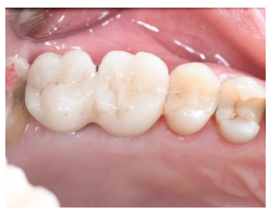 JCM | Free Full-Text | Long-Term Outcomes of Implants Placed in ...