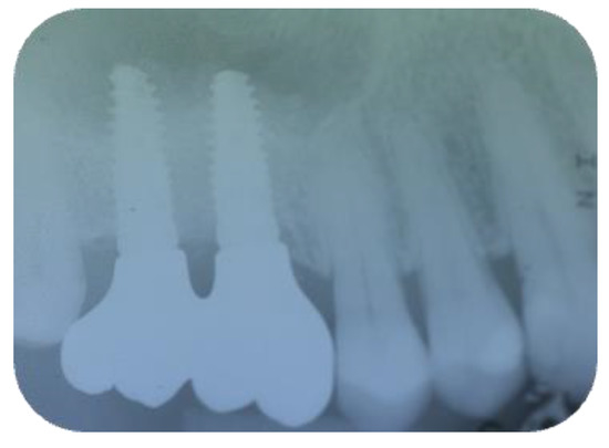 JCM | Free Full-Text | Long-Term Outcomes of Implants Placed in ...