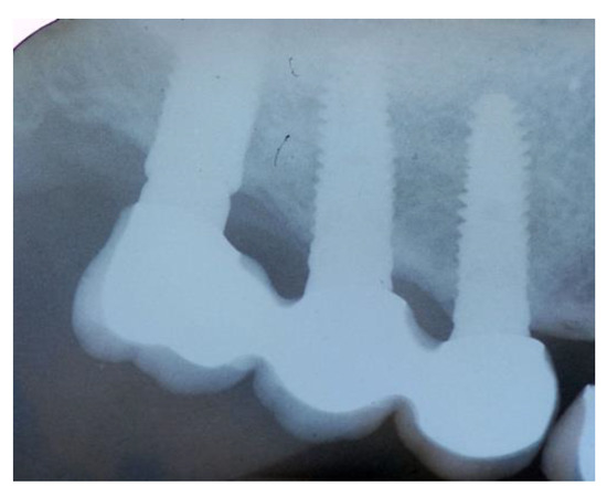 JCM | Free Full-Text | Long-Term Outcomes of Implants Placed in ...