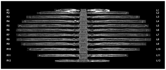 Assessment of Rib Fracture in Acute Trauma Using Automatic Rib Segmentation and a Curved ...