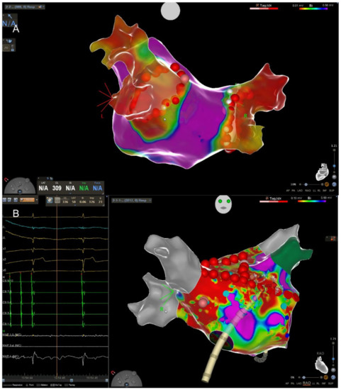 Atrial Fibrillation and Heart Failure
