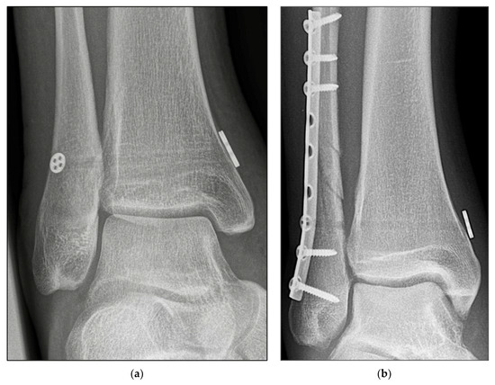 A 10-Year Follow-Up of Ankle Syndesmotic Injuries: Prospective ...
