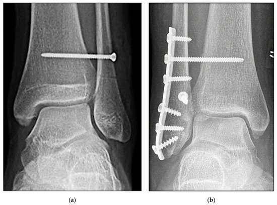 A 10-Year Follow-Up of Ankle Syndesmotic Injuries: Prospective Comparison of Knotless Suture ...