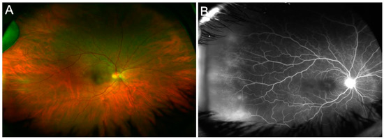 A Comprehensive Update on Retinal Vasculitis: Etiologies ...