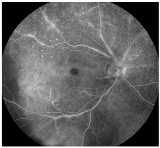 A Comprehensive Update on Retinal Vasculitis: Etiologies ...