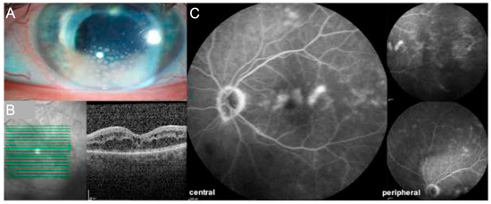 A Comprehensive Update on Retinal Vasculitis: Etiologies ...