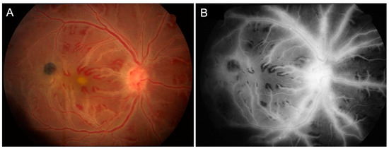 A Comprehensive Update on Retinal Vasculitis: Etiologies ...