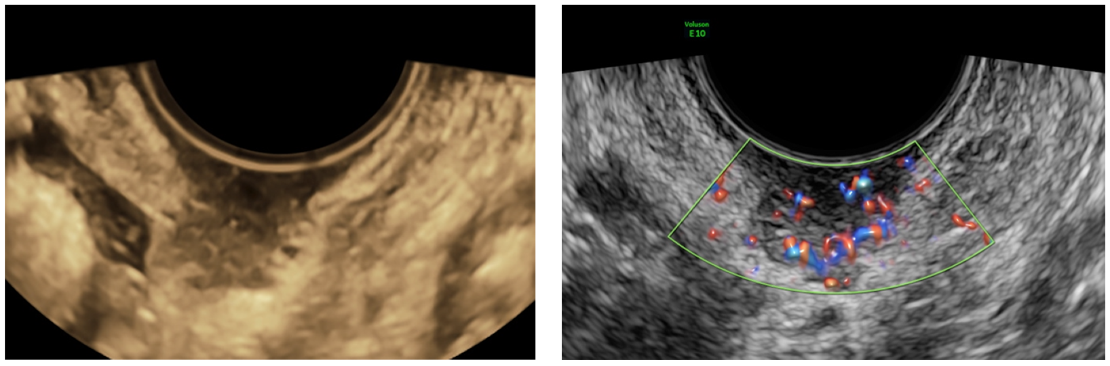 Jcm Free Full Text Ultrasound Guided Tru Cut Biopsy In