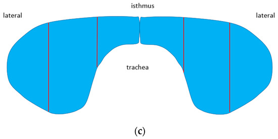 Introducing a Pole Concept for Nodule Growth in the Thyroid Gland ...