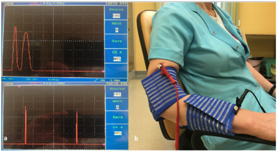 Analgesic and Functional Efficiency of High-Voltage Electrical ...