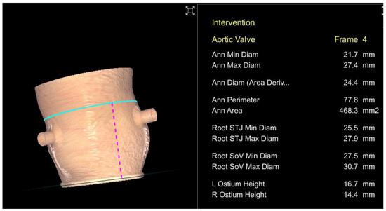 Preoperative TAVR Planning: How to Do It