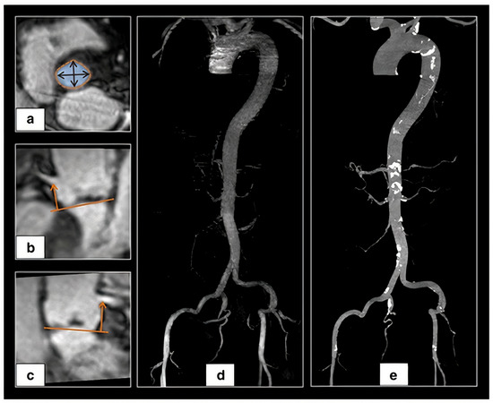 Preoperative TAVR Planning: How to Do It