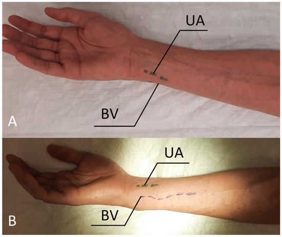 Prone Position Facilitates Creation of Ulnar-Basilic Arteriovenous Fistula