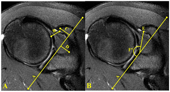 JCM | Free Full-Text | Coracoid Impingement and Morphology Is ...