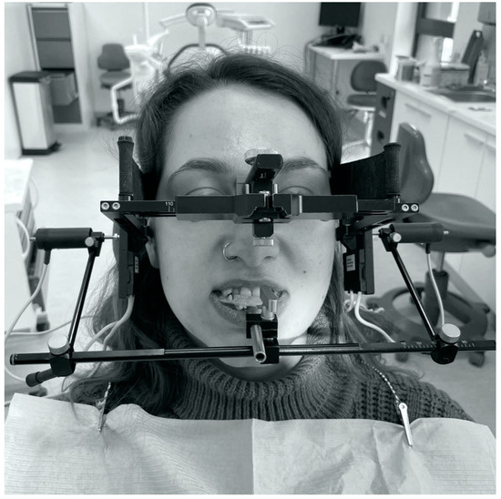 Sagittal Condylar Inclination and Transversal Condylar Inclination in ...