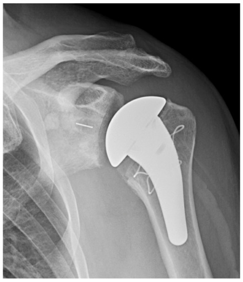 JCM | Free Full-Text | Innovations in Shoulder Arthroplasty