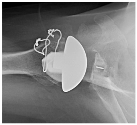 JCM | Free Full-Text | Innovations in Shoulder Arthroplasty