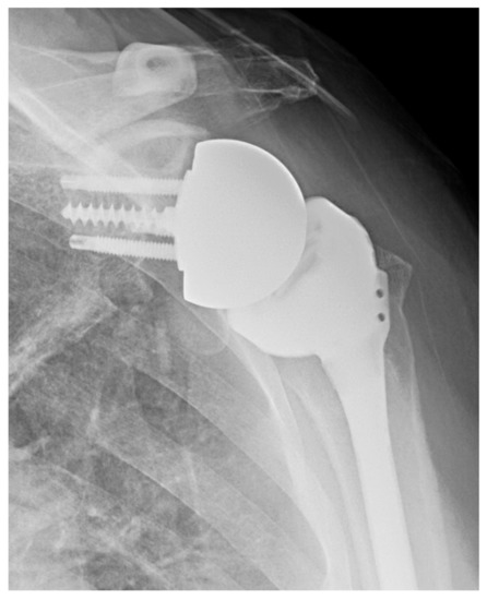 Innovations in Shoulder Arthroplasty