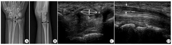 Correlation between Electrodiagnostic Study and Imaging Features in ...