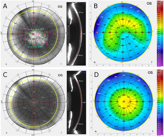 Correlation of Clinical Fibrillar Layer Detection and Corneal Thickness ...