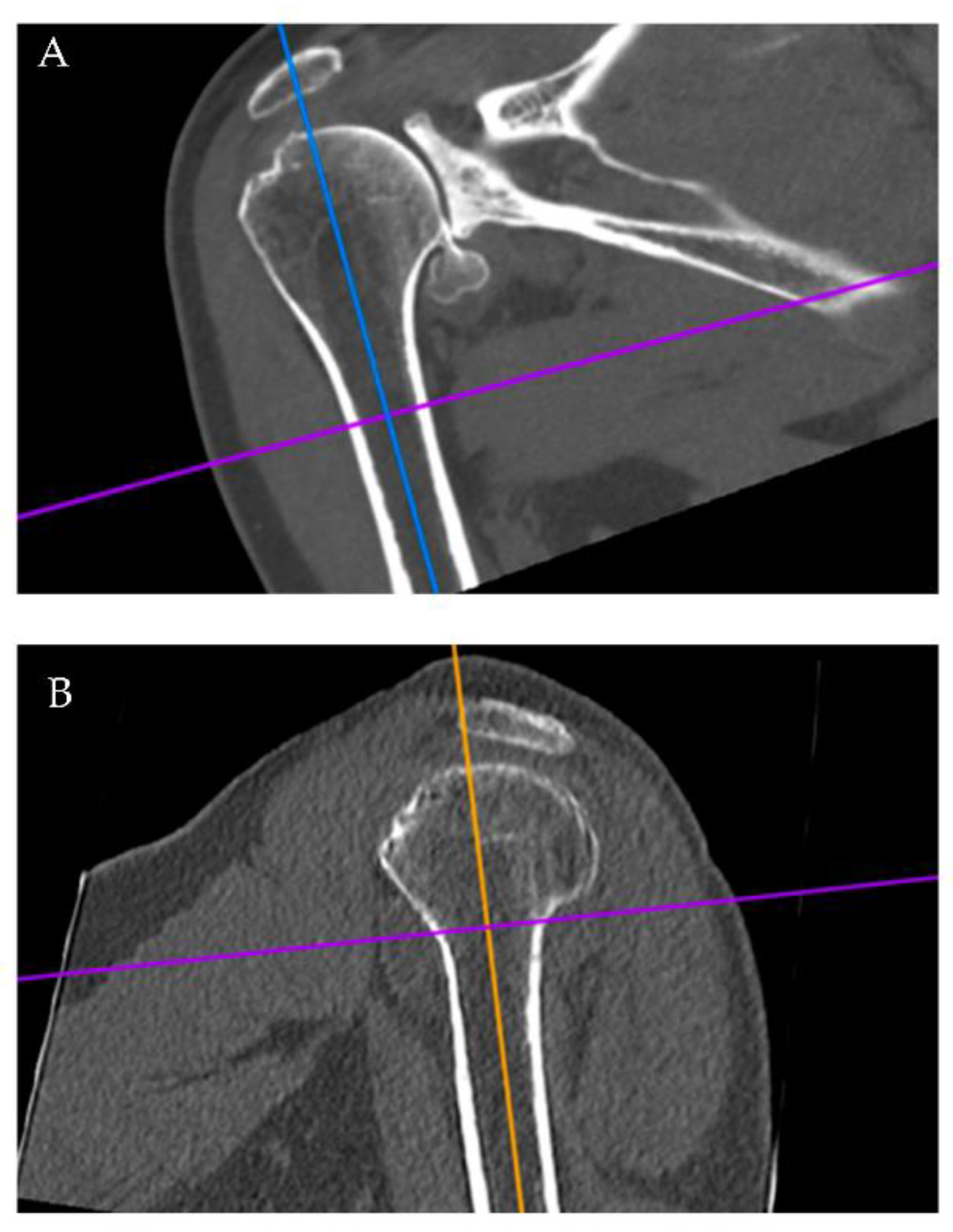 A Radiographic Analysis of Proximal Humeral Anatomy in Patients with ...