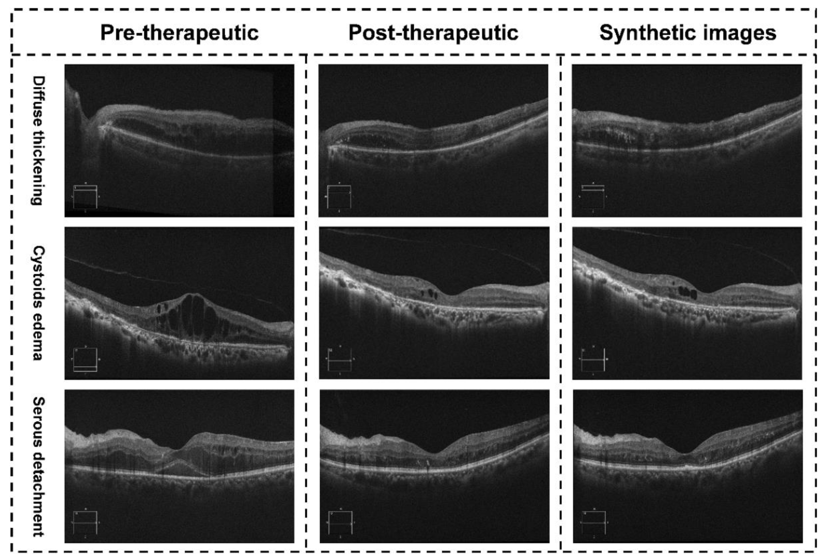 Prediction of the Short-Term Therapeutic Effect of Anti-VEGF Therapy ...