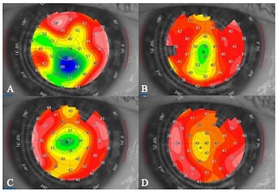 Corneal Findings Associated to Belantamab-Mafodotin (Belamaf) Use in a ...