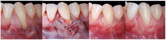 Double Lateral Sliding Bridge Flap versus Laterally Closed Tunnel for ...
