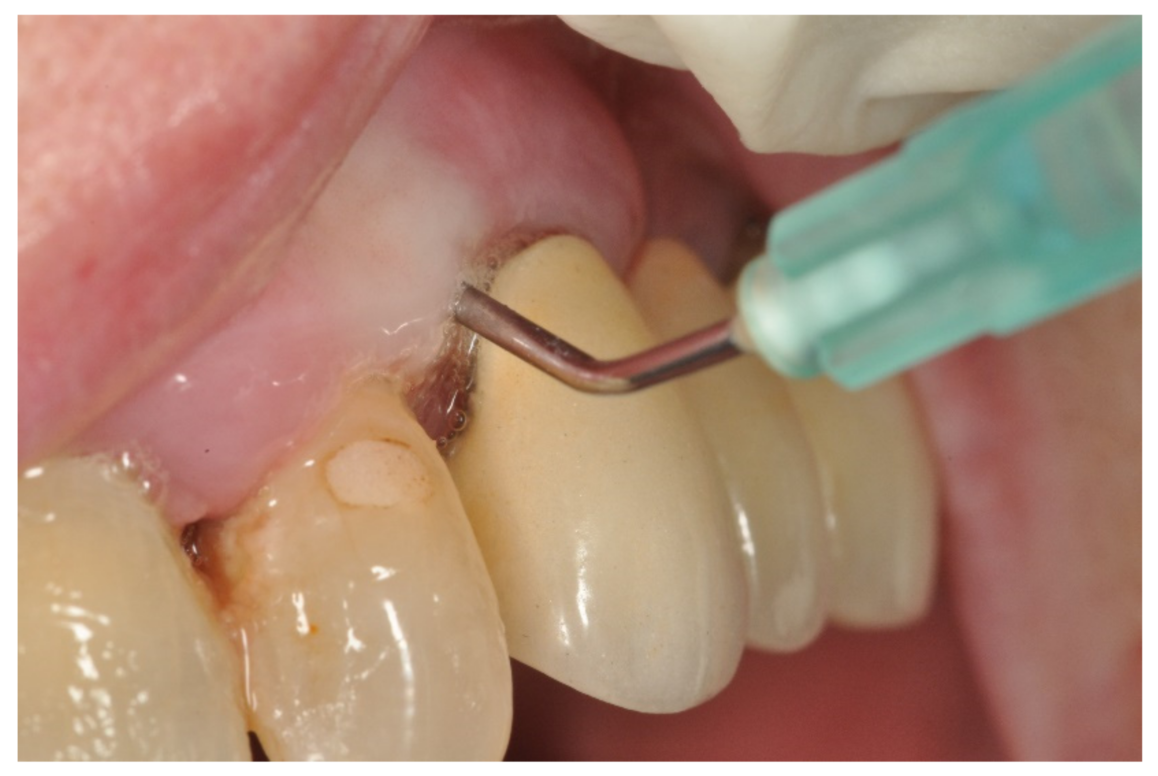 JCM | Free Full-Text | Ozone in Patients with Periodontitis: A Clinical and Microbiological Study
