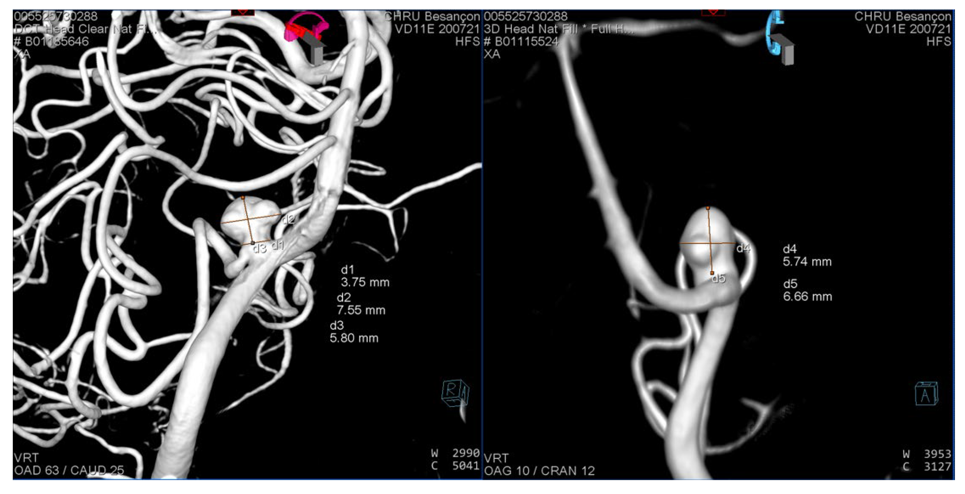 Pre-Interventional 3D-Printing-Assisted Planning of Flow Disrupter ...