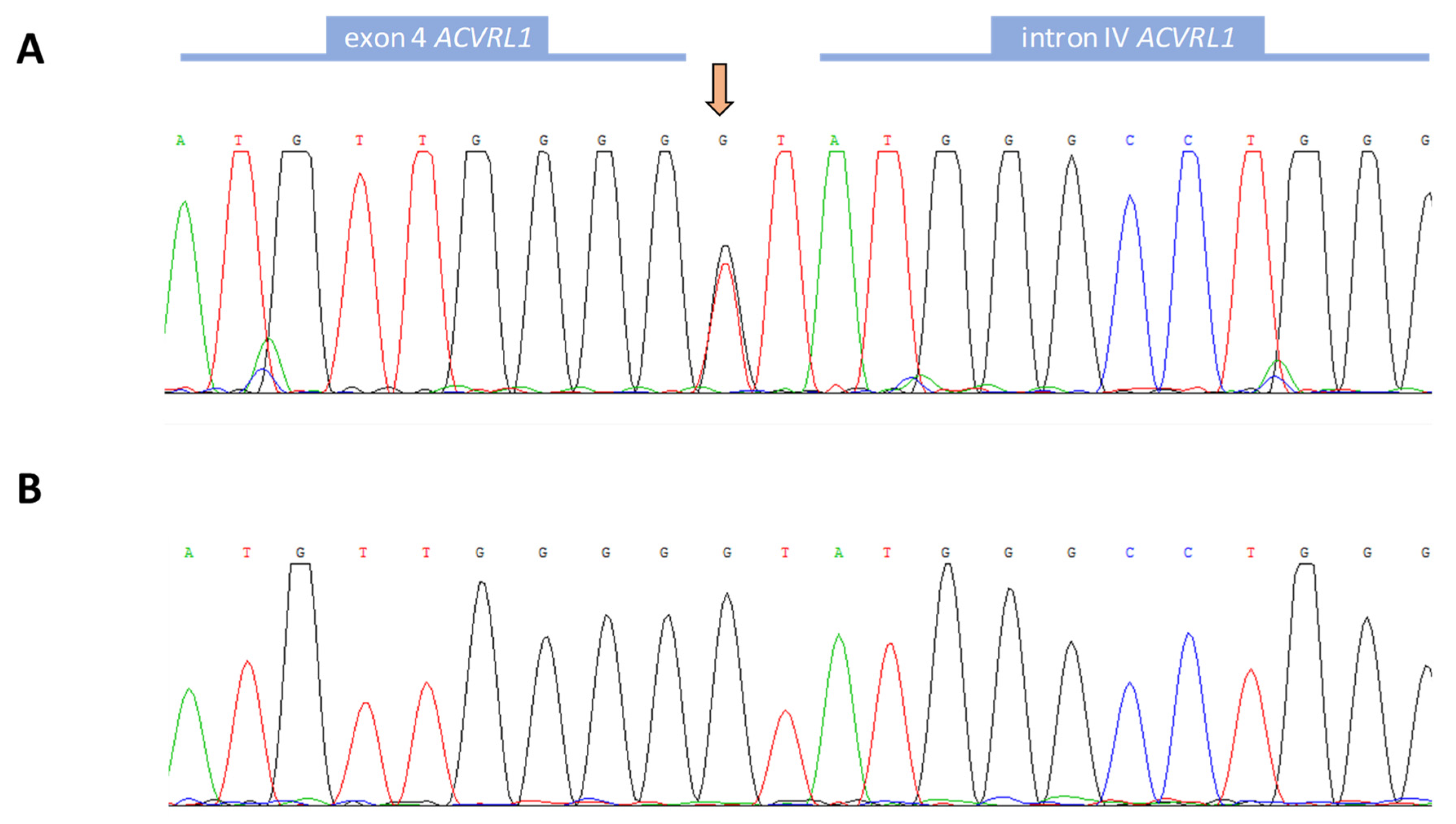 A Novel Splicing Mutation in the ACVRL1/ALK1 Gene as a Cause of HHT2