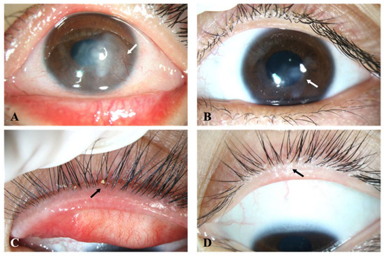 Safety and Feasibility of Low Fluence Intense Pulsed Light for Treating ...