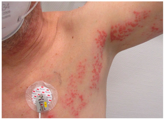 Coronary Artery Bypass Graft Scar