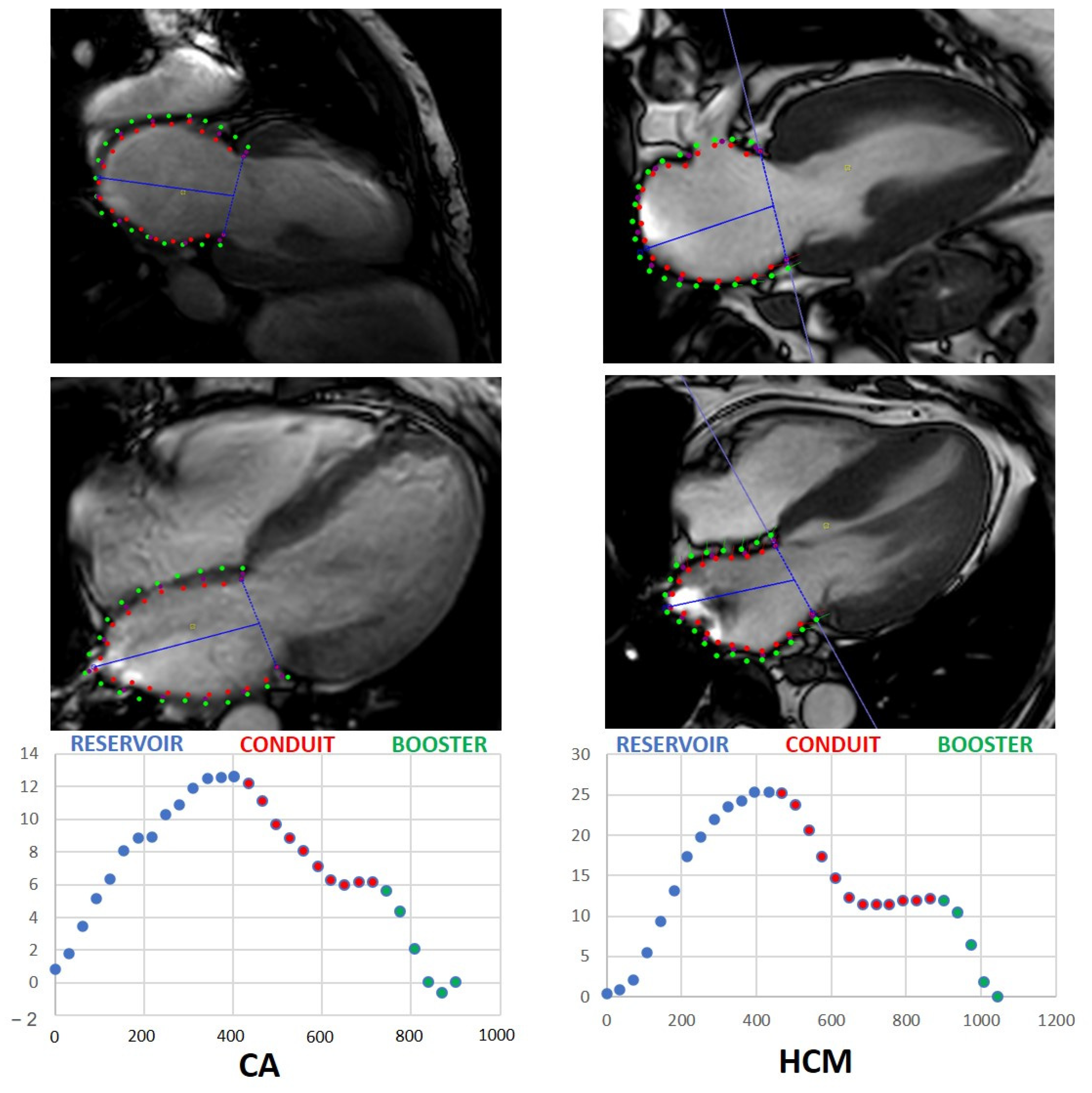 Magnetic-Resonance-Imaging-Based Left Atrial Strain and Left Atrial ...