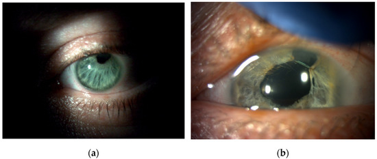 Visual Outcomes of Pupilloplasty in Ocular Trauma and Iatrogenic Damage
