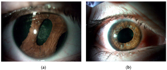 Visual Outcomes of Pupilloplasty in Ocular Trauma and Iatrogenic Damage