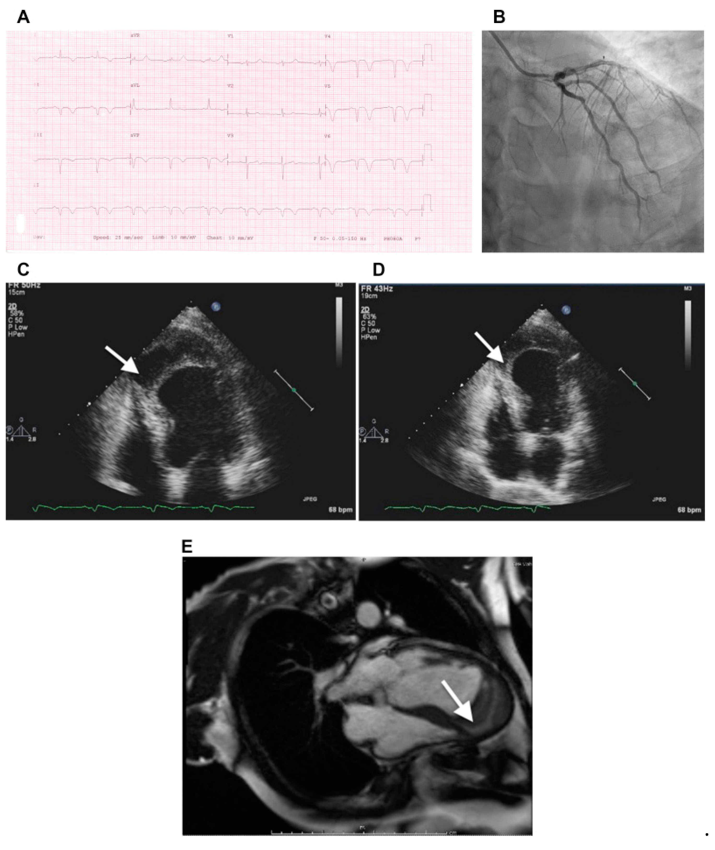 The Interventricular Septum: Structure, Function, Dysfunction, and Diseases