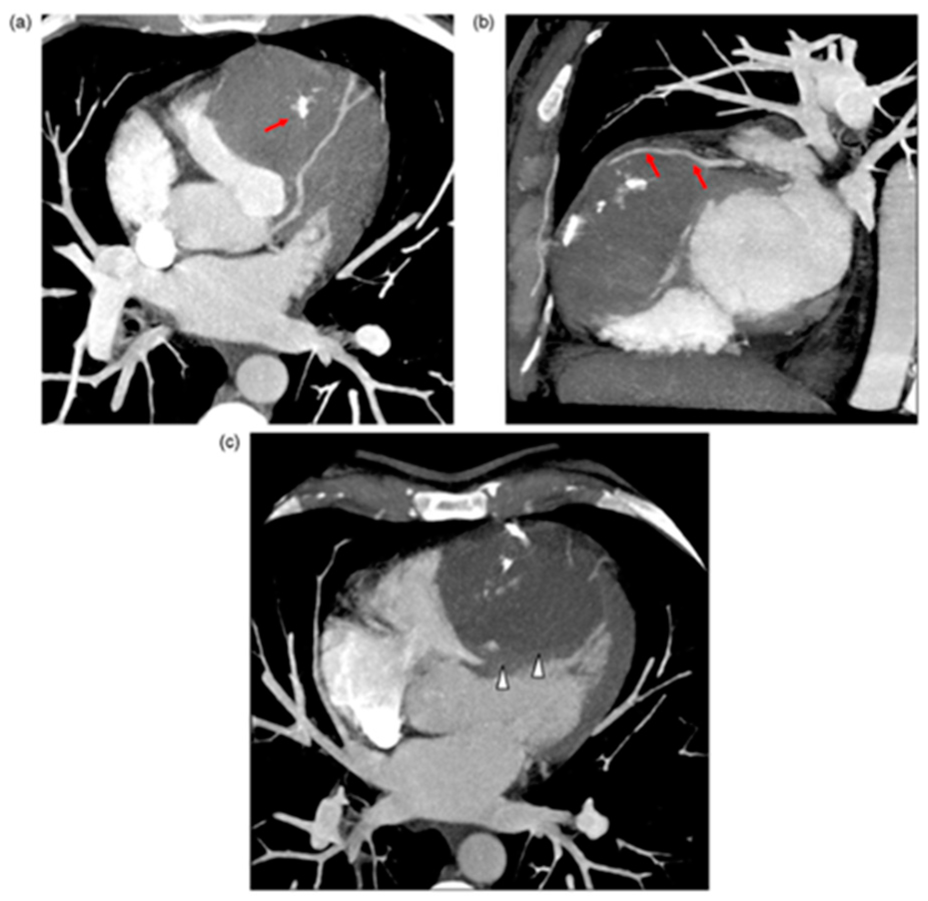 The Interventricular Septum: Structure, Function, Dysfunction, and Diseases