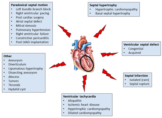 JCM | Free Full-Text | The Interventricular Septum: Structure, Function ...