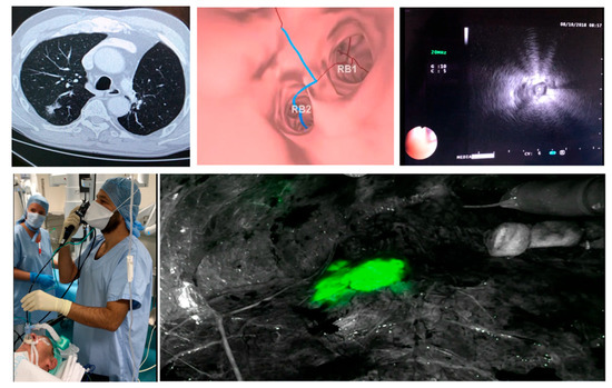 JCM | Free Full-Text | How Bronchoscopic Dye Marking Can Help Minimally ...