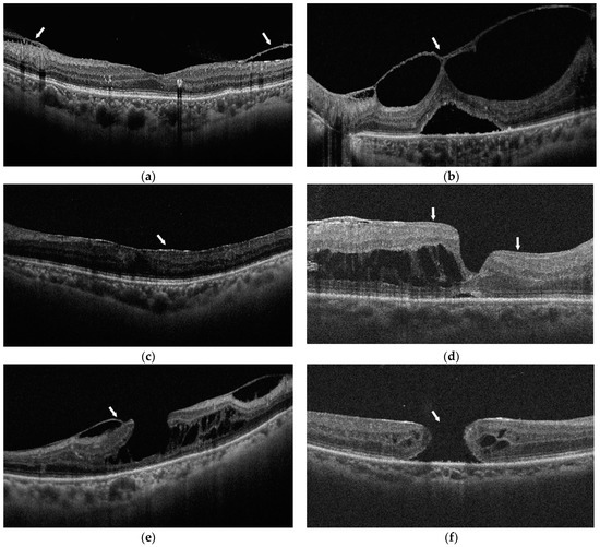 Vitreomacular Interface Disorders in Proliferative Diabetic Retinopathy ...
