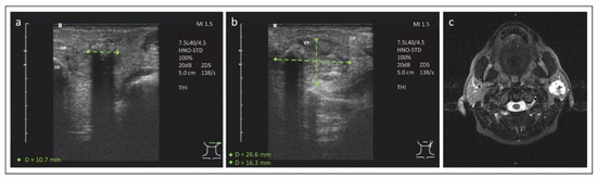 Calcification in Salivary Gland Cancer Mimicking Sialolithiasis—A ...