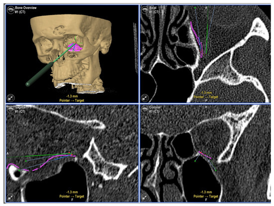 Primary Orbital Reconstruction with Selective Laser Melting (SLM) of ...