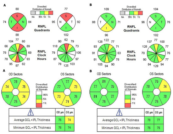 JCM | Free Full-Text | OCT Results in Myopia: Diagnostic Difficulties ...