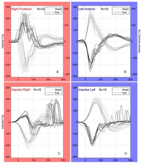 JCM | Free Full-Text | Video Head Impulse Test (vHIT): Value of Gain ...