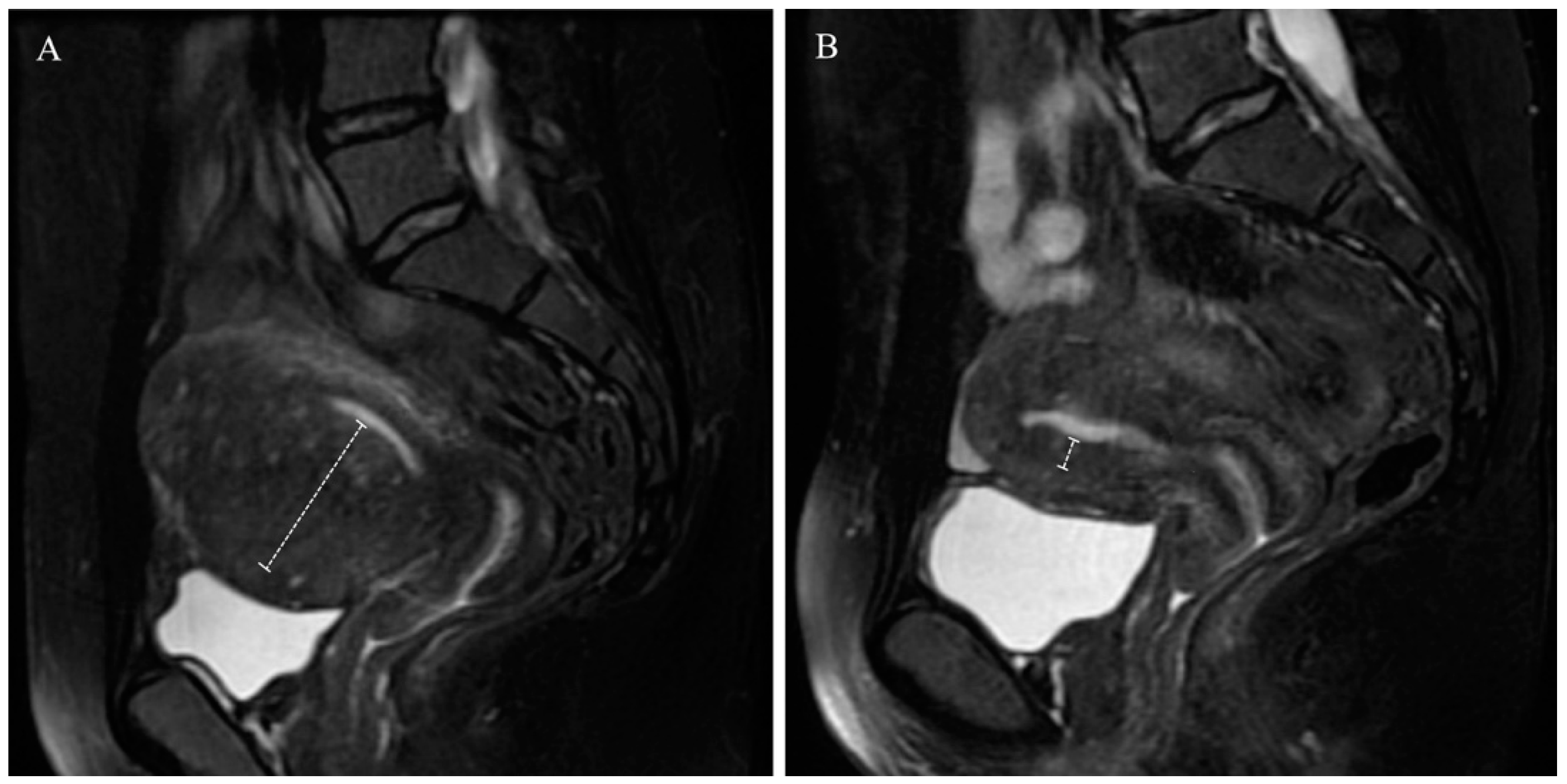 Jcm Free Full Text Long Term Pregnancy Outcomes Of Patients With